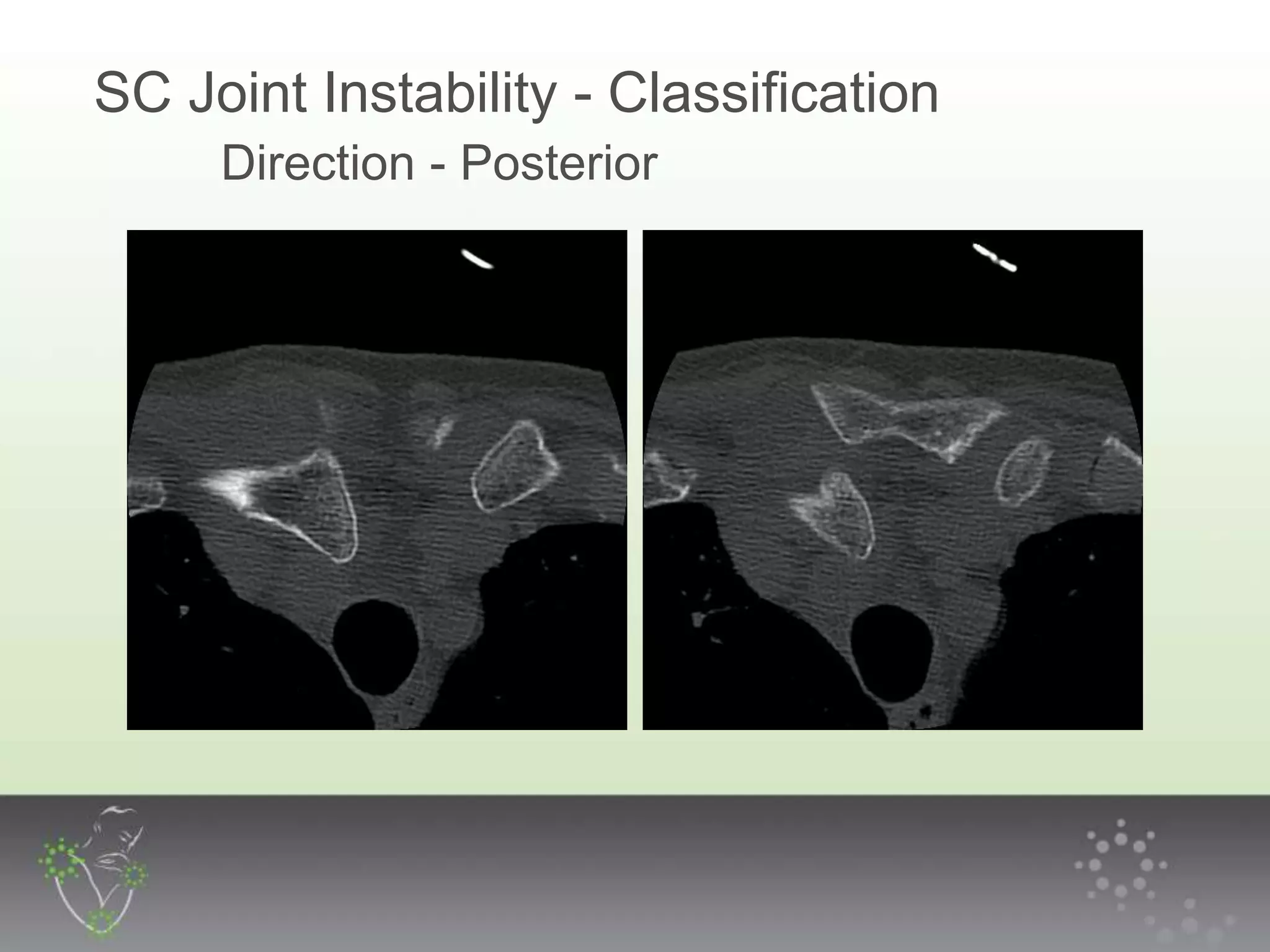 The Sternoclavicular Joint | PPTX