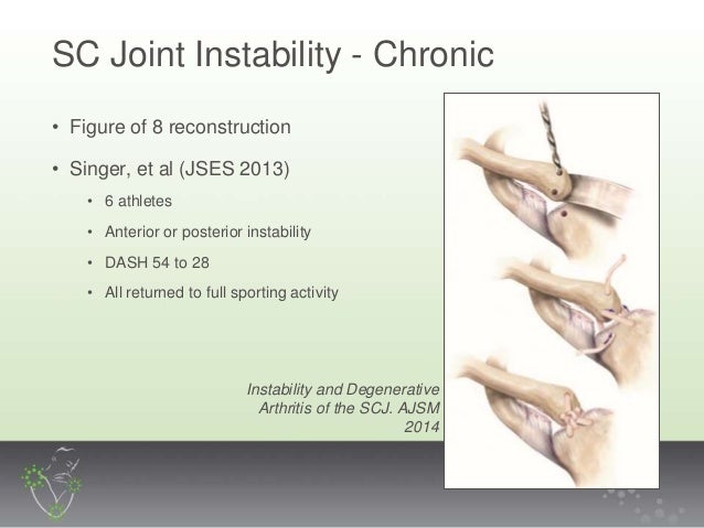 Sternoclavicular Joint Injection