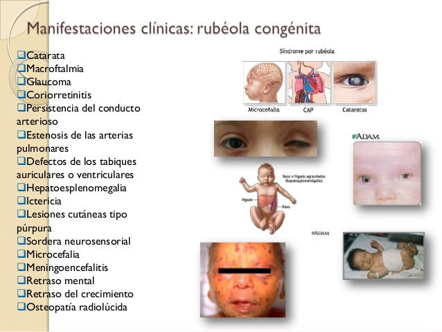 enfermedades infectocontagiosas: rubéola