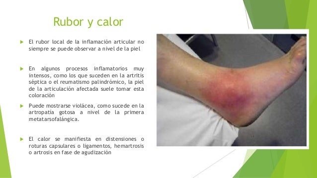 tumefaccion rubor calor, chasquidos crujidos roces de las articulaci…