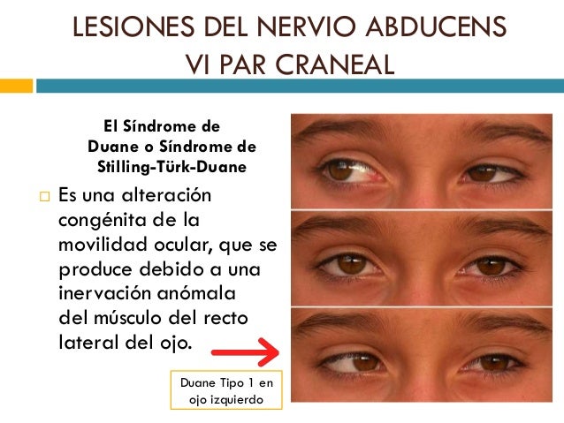 ANATOMÍA DEL VI PAR CRANEAL - NERVIO ABDUCENS