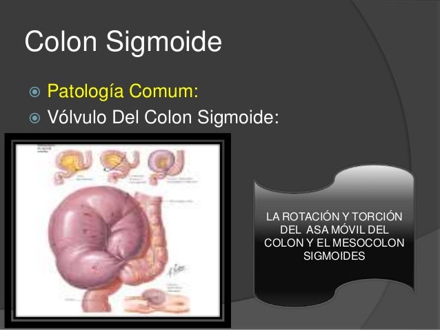 Exposición colon y volvulo sigmoide