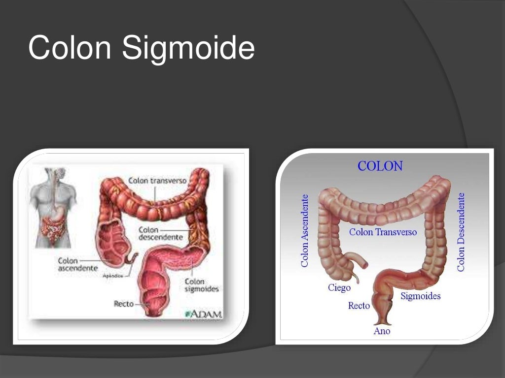 Exposición colon y volvulo sigmoide