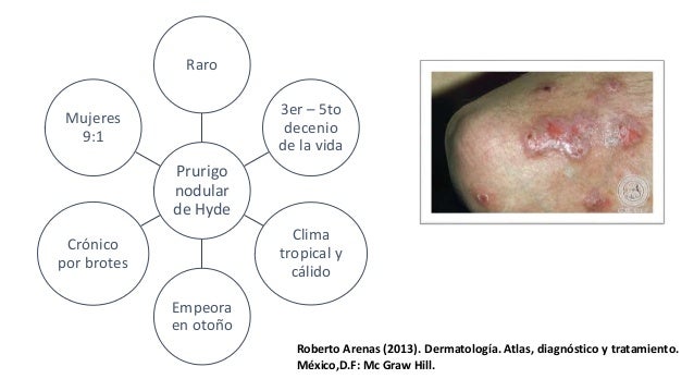 Urticaria y Prurigo Nodular de Hyde