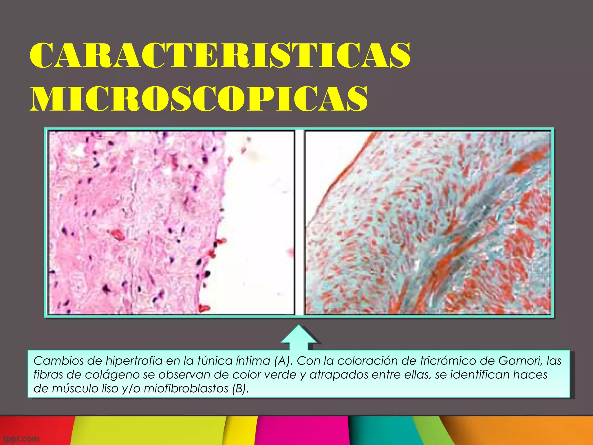 insuficiencia venosa - varices | PPT