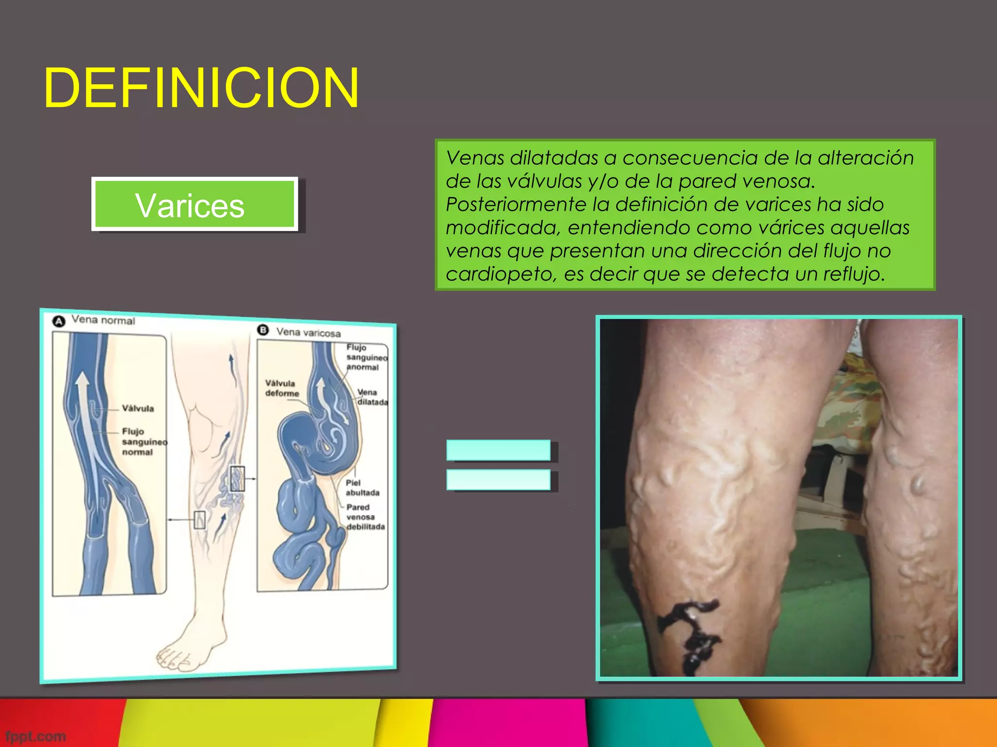 insuficiencia venosa - varices | PPT