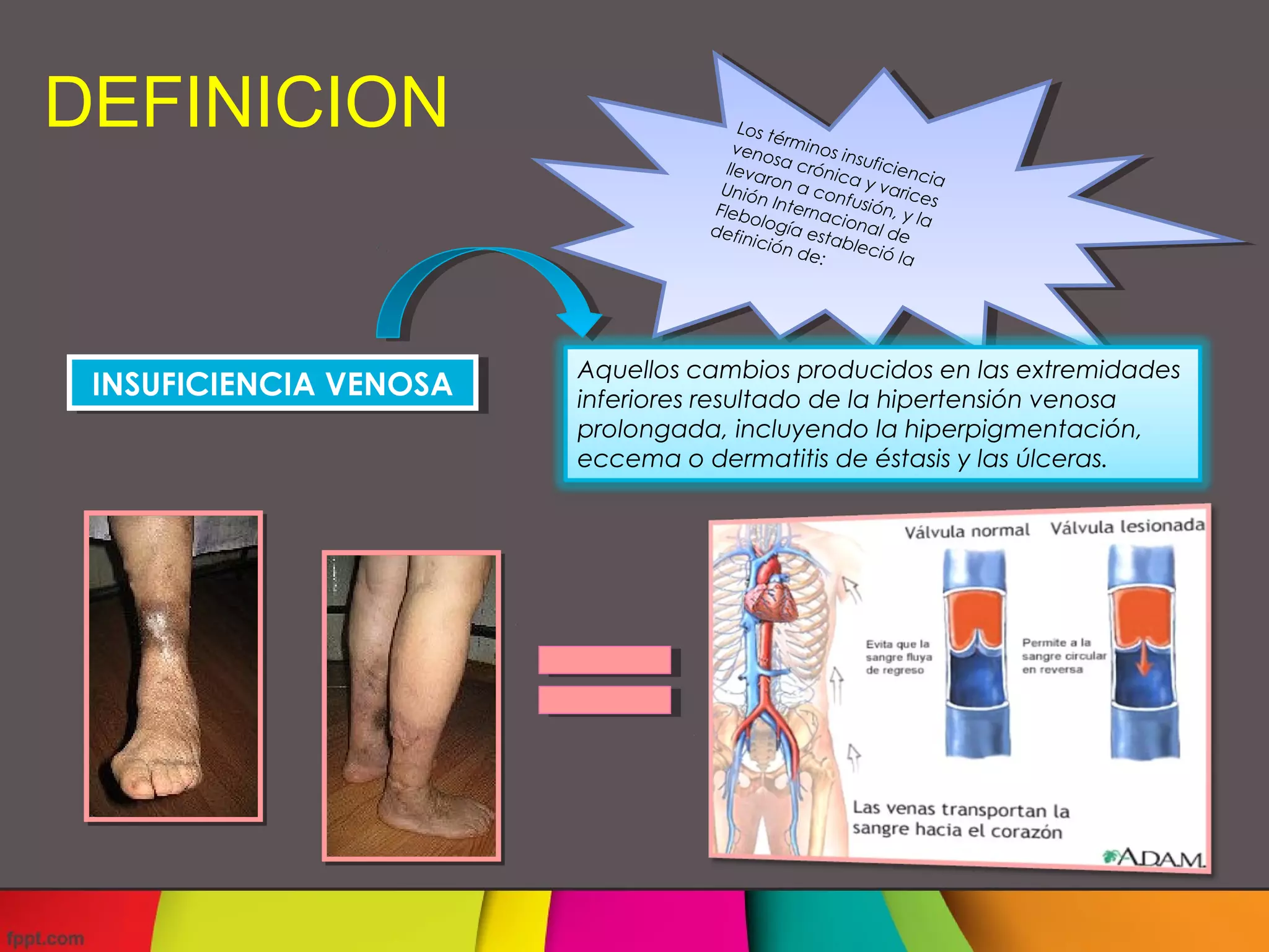insuficiencia venosa - varices | PPT