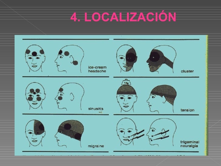 Exposicion De Cefalea..