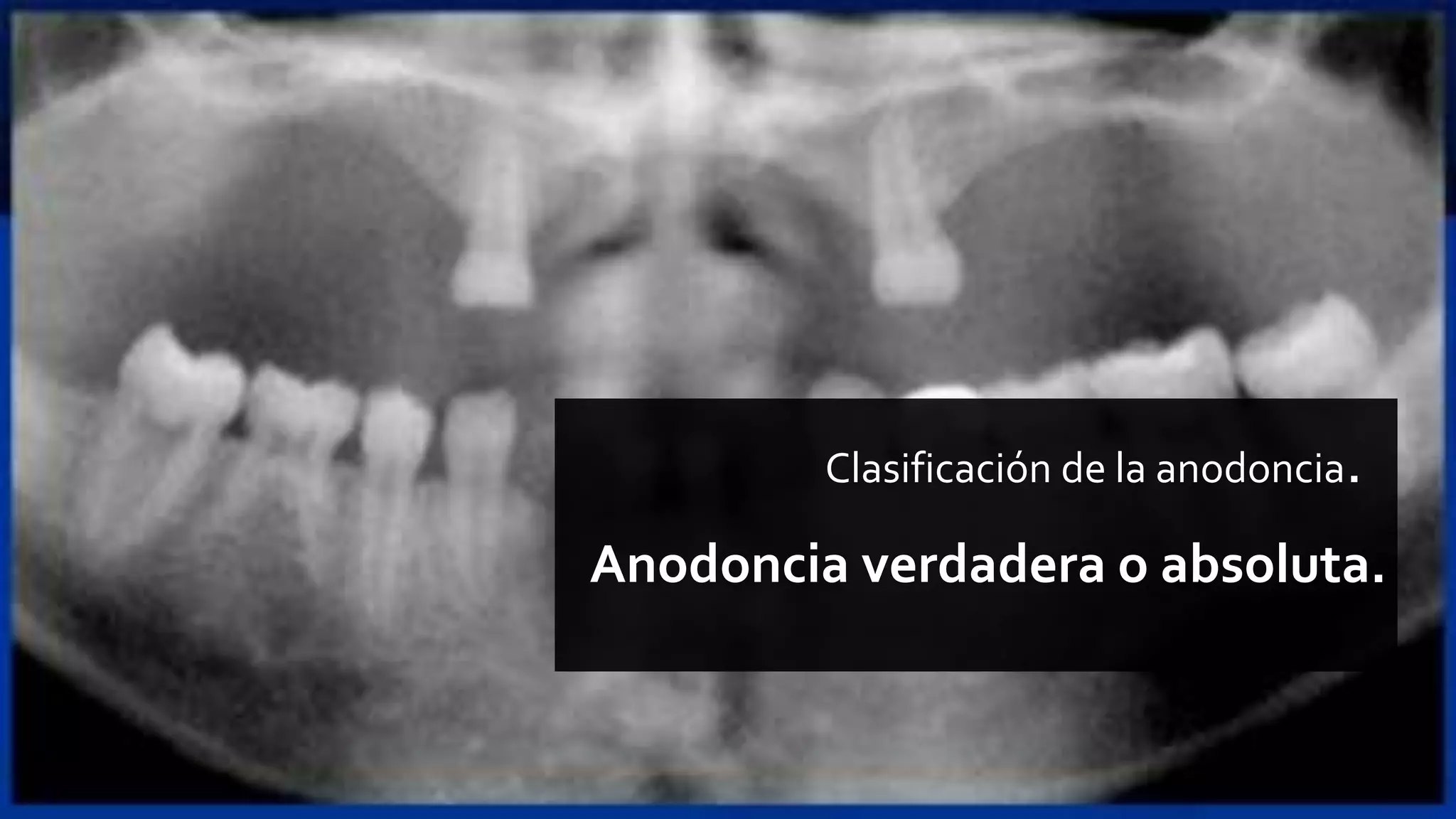 Anodoncia | PPT | Descarga Gratuita
