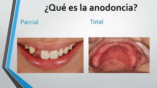 ANODONCIA | PPTX