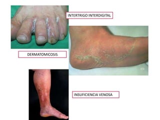 EXPOSICION CELULITIS.pptx