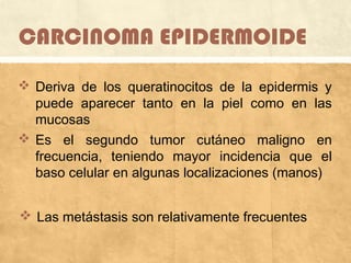 Carcinoma epidermoide | PPT