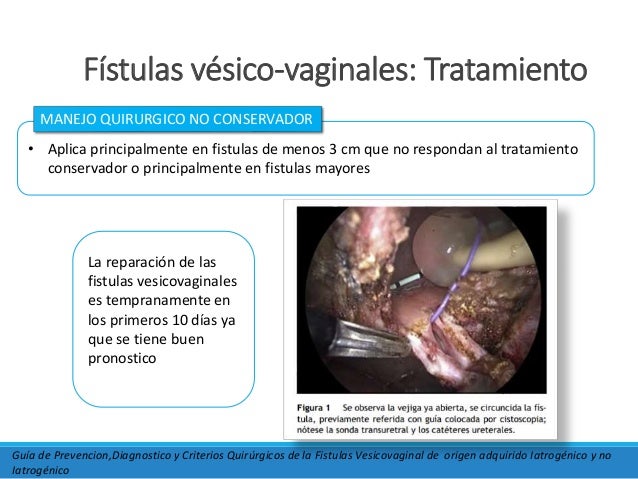 FISTULAS UROLOGICAS