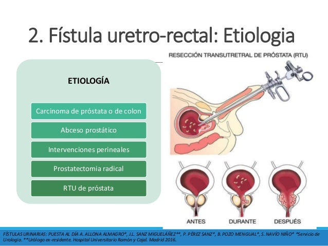 FISTULAS UROLOGICAS