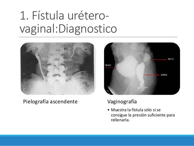FISTULAS UROLOGICAS