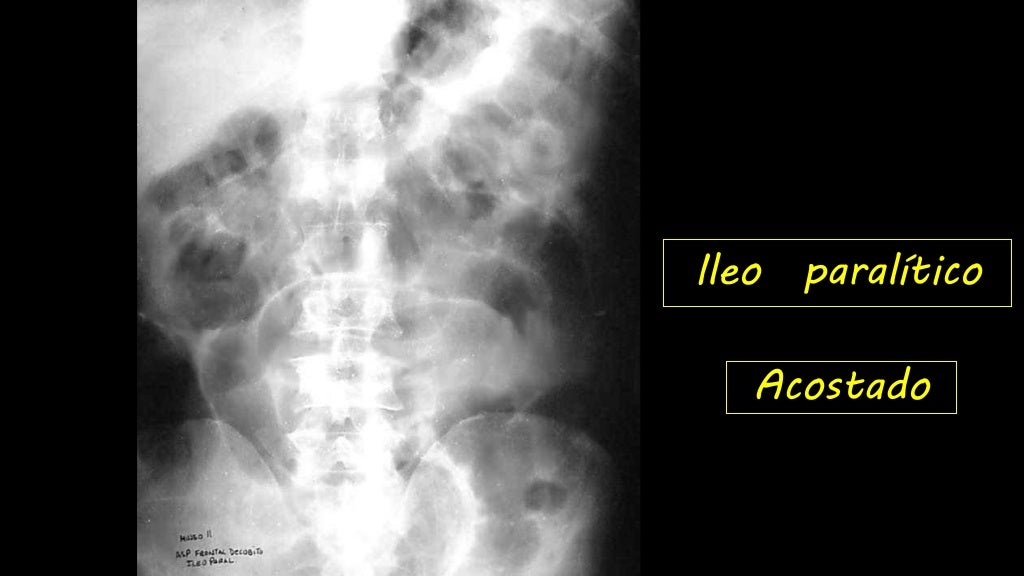ILEO INTESTINAL