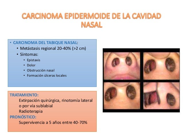 Exposicion de nariz y patologias dr fonseca