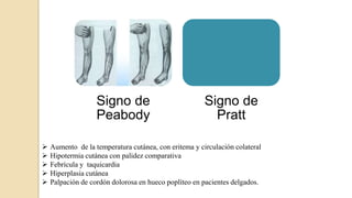 trombosis venosa profunda | PPTX