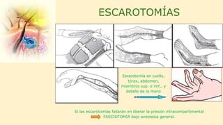 EXPOSICION DE QUEMADURAS 2022.pptx