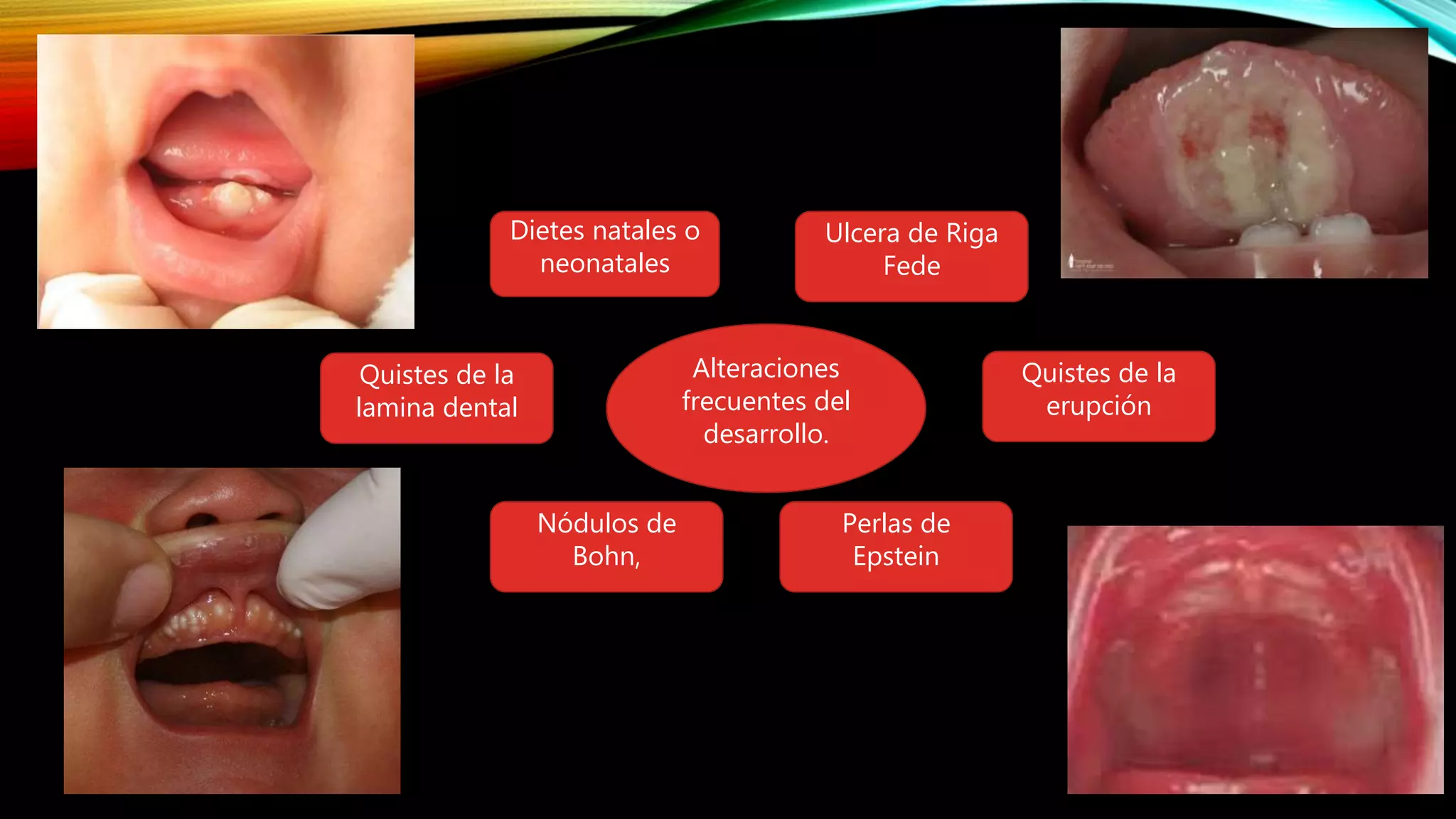Morfología y alteraciones bucales en el recién nacido | PPT