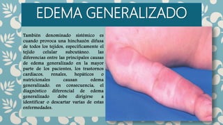 edema | PPTX