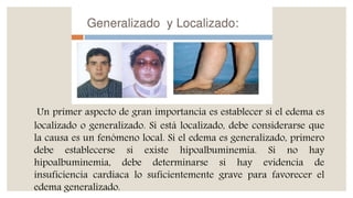 edema | PPTX
