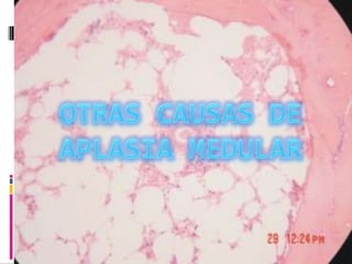 Aplasia medular | PPTX