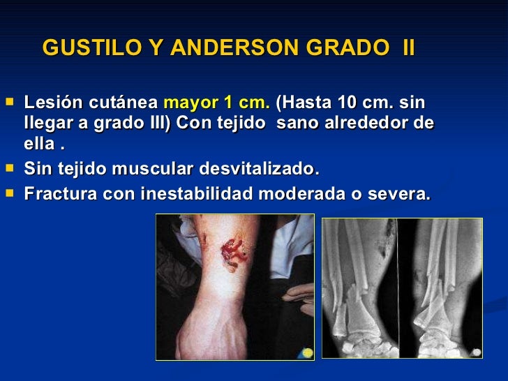 Exposicion Fracturas Expuestas