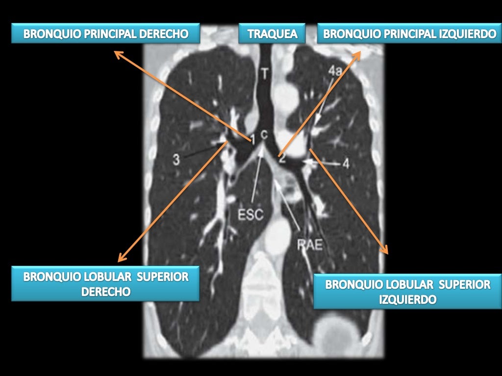 intersticio pulmonar