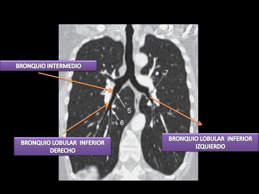 intersticio pulmonar