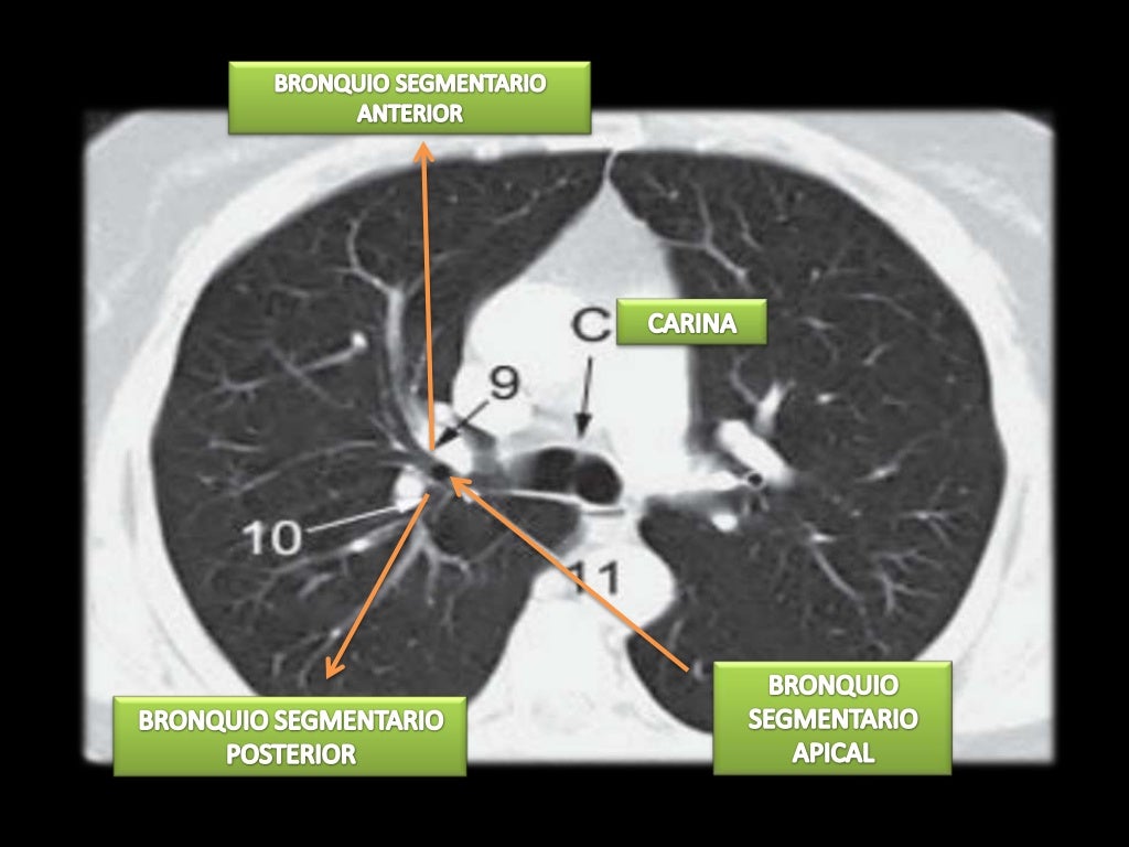 intersticio pulmonar