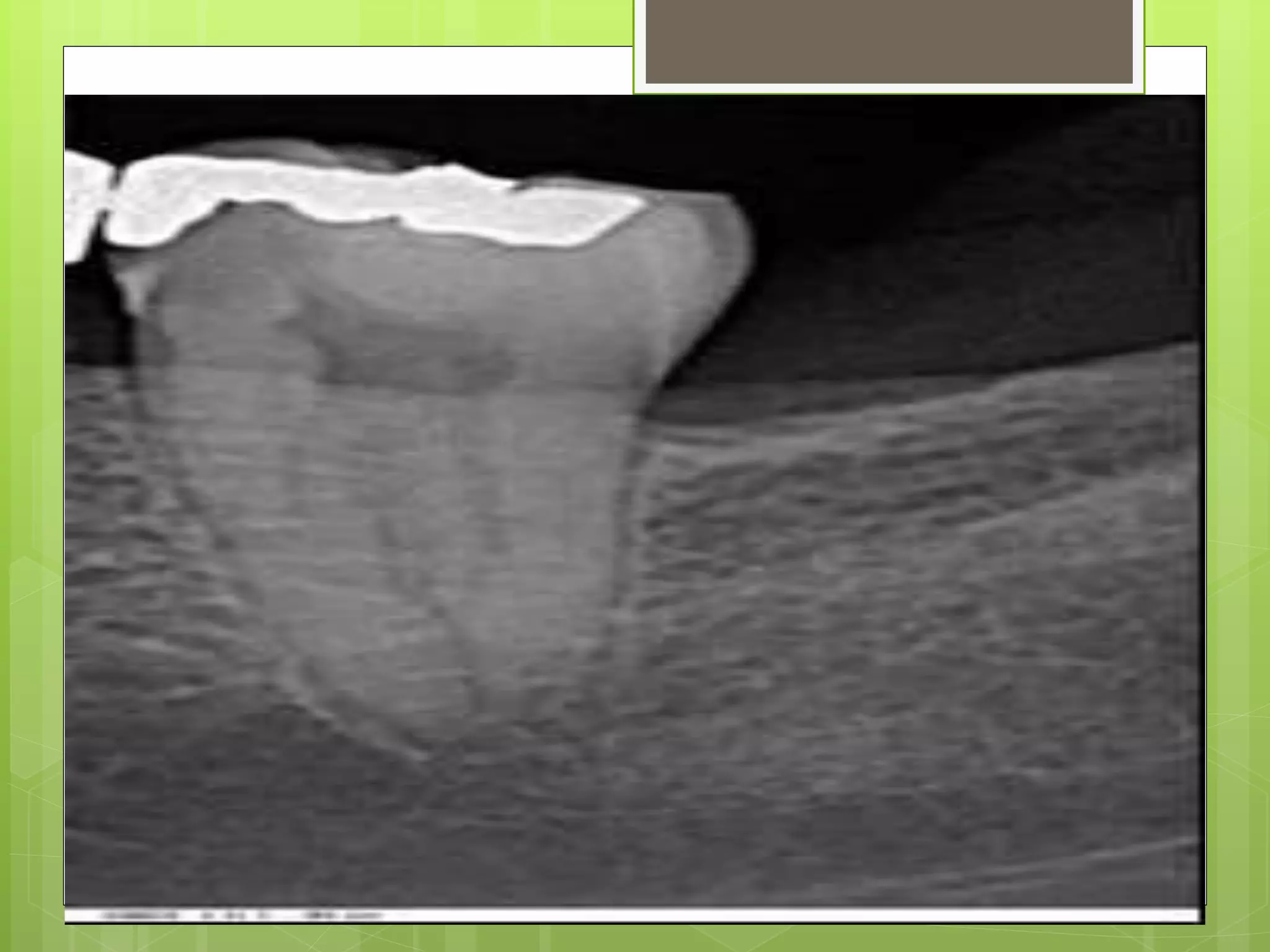 radiologia caries dental | PPTX