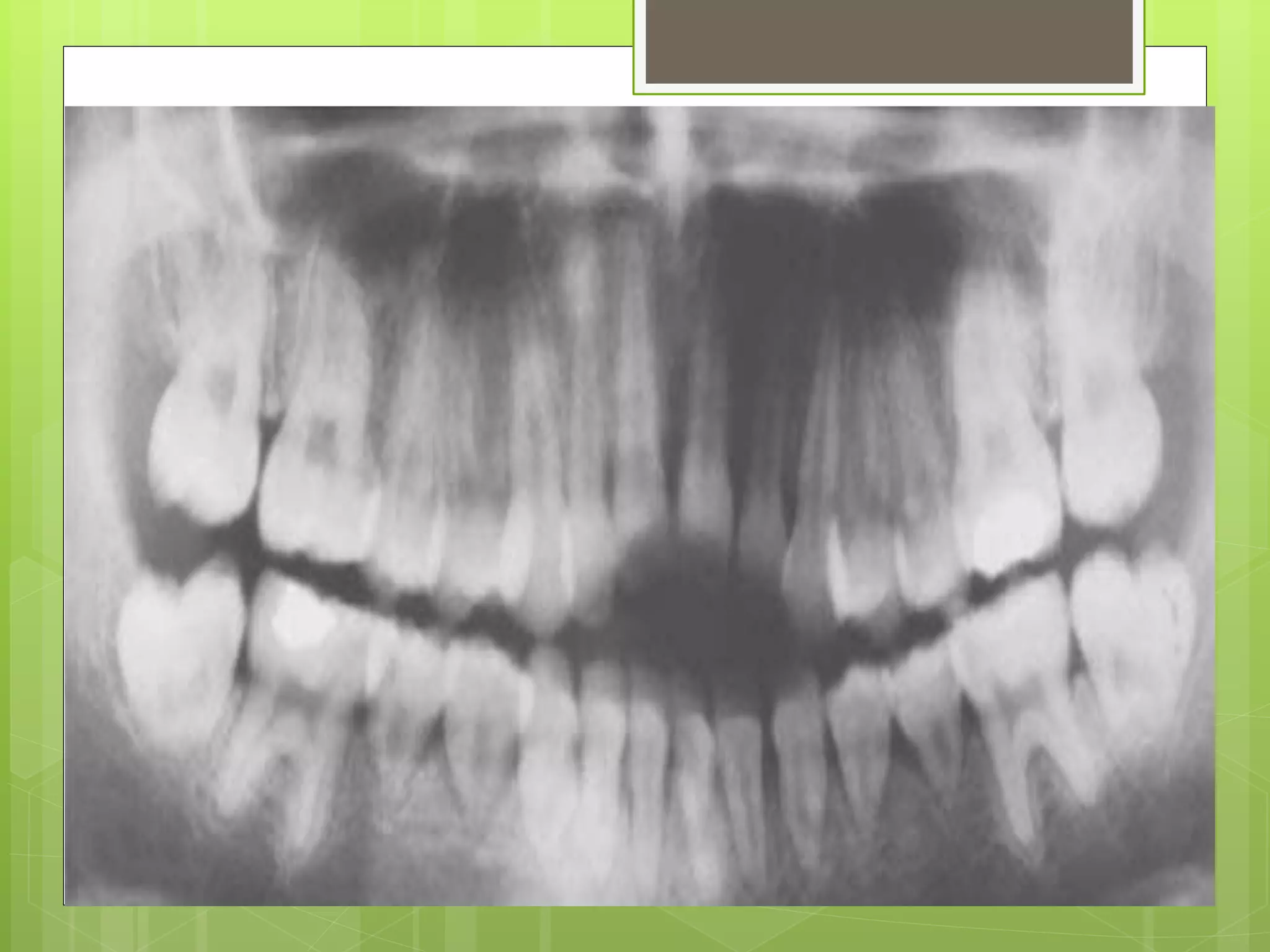 radiologia caries dental | PPTX