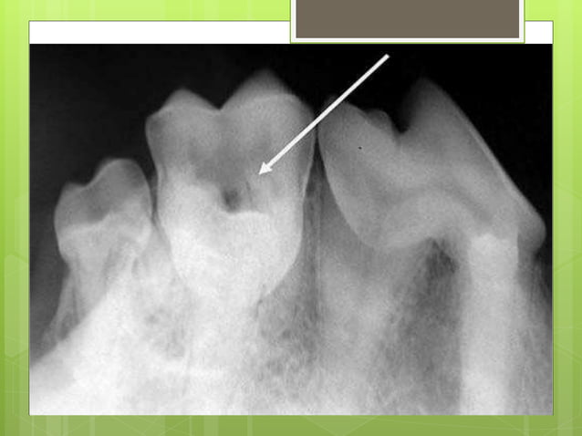 radiologia caries dental | PPTX