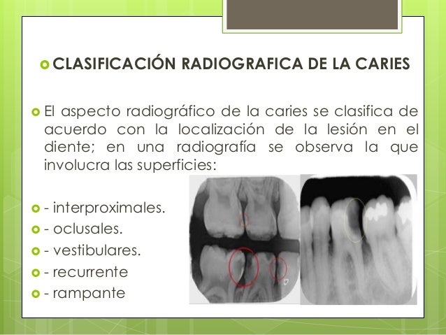 radiologia caries dental