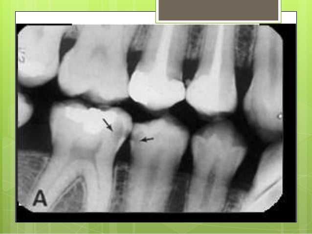 radiologia caries dental