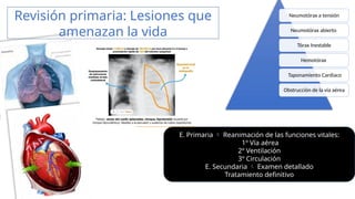 EXPOSICION TRAUMA TORÁCICO HSR PIURA 2021.pptx