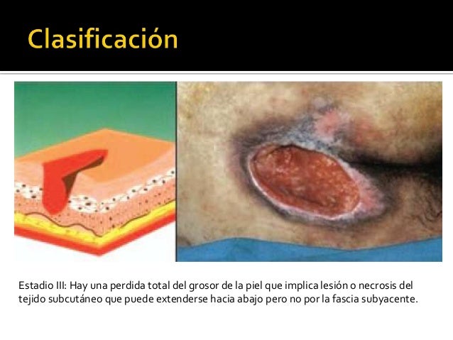 Ulceras por presión UPP