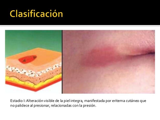 Ulceras por presión UPP