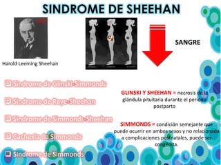 Sindrome de Sheehan | PPTX