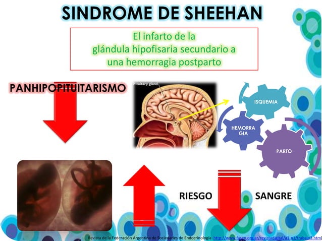 Sindrome de Sheehan