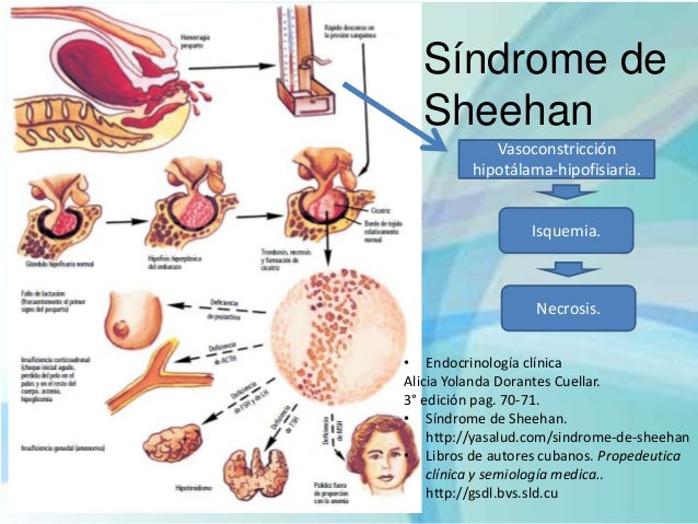 Sindrome de Sheehan