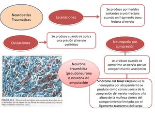 PATOLOGÍA DEL NERVIO PERIFERICO | PPTX