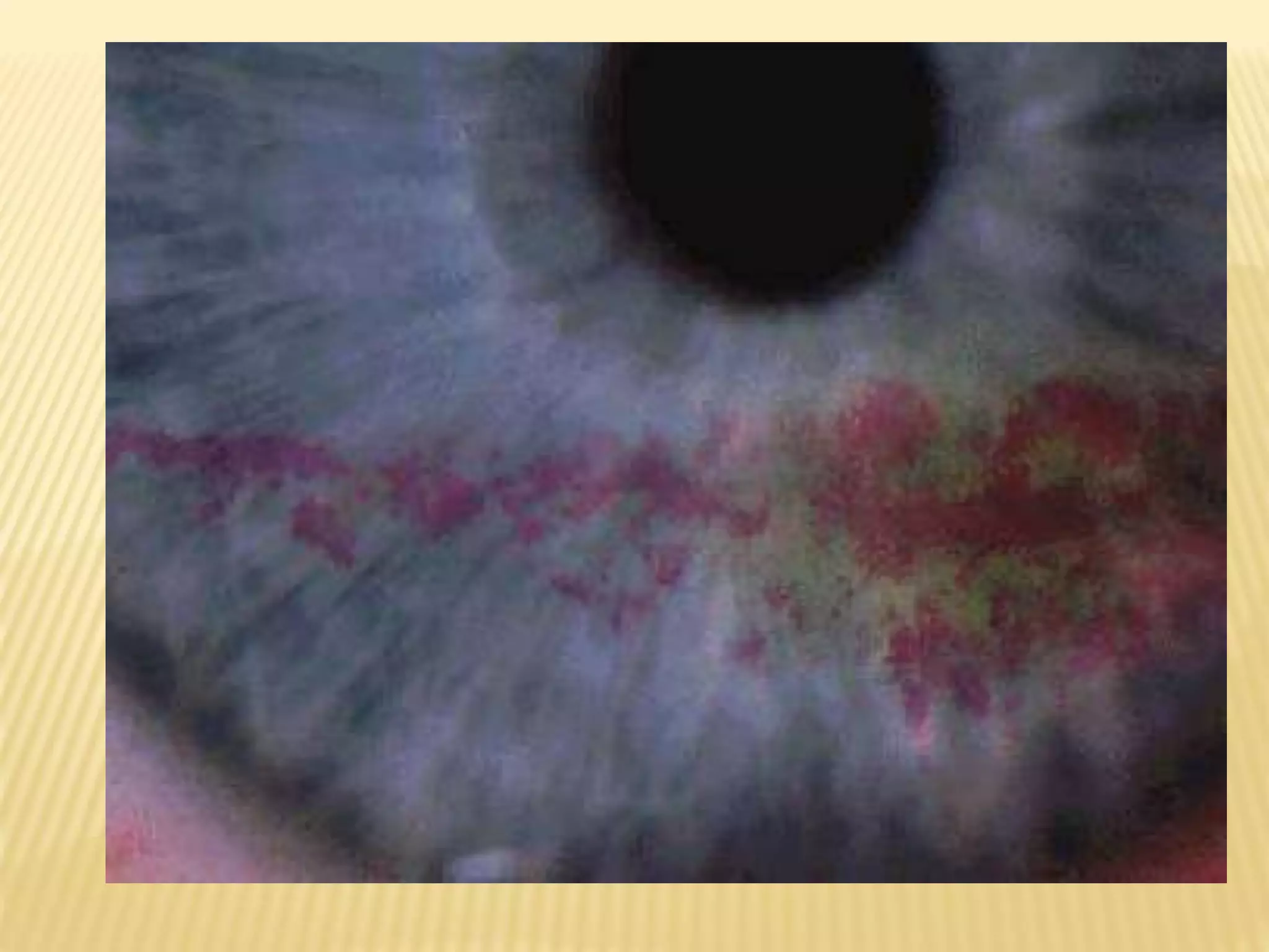 Exposure keratopathy | PPTX