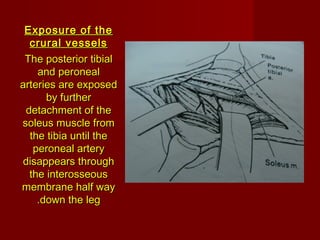 Posterior Tibial Artery Exposure