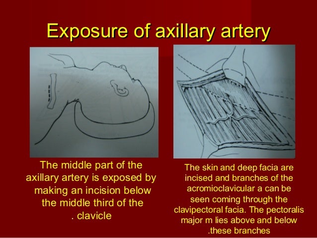 Exposure of major blood vessels