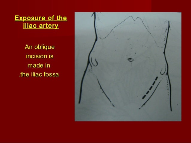 Exposure of major blood vessels