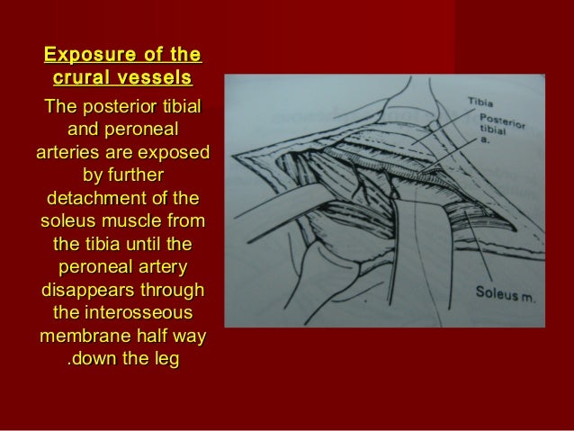 Exposure of major blood vessels