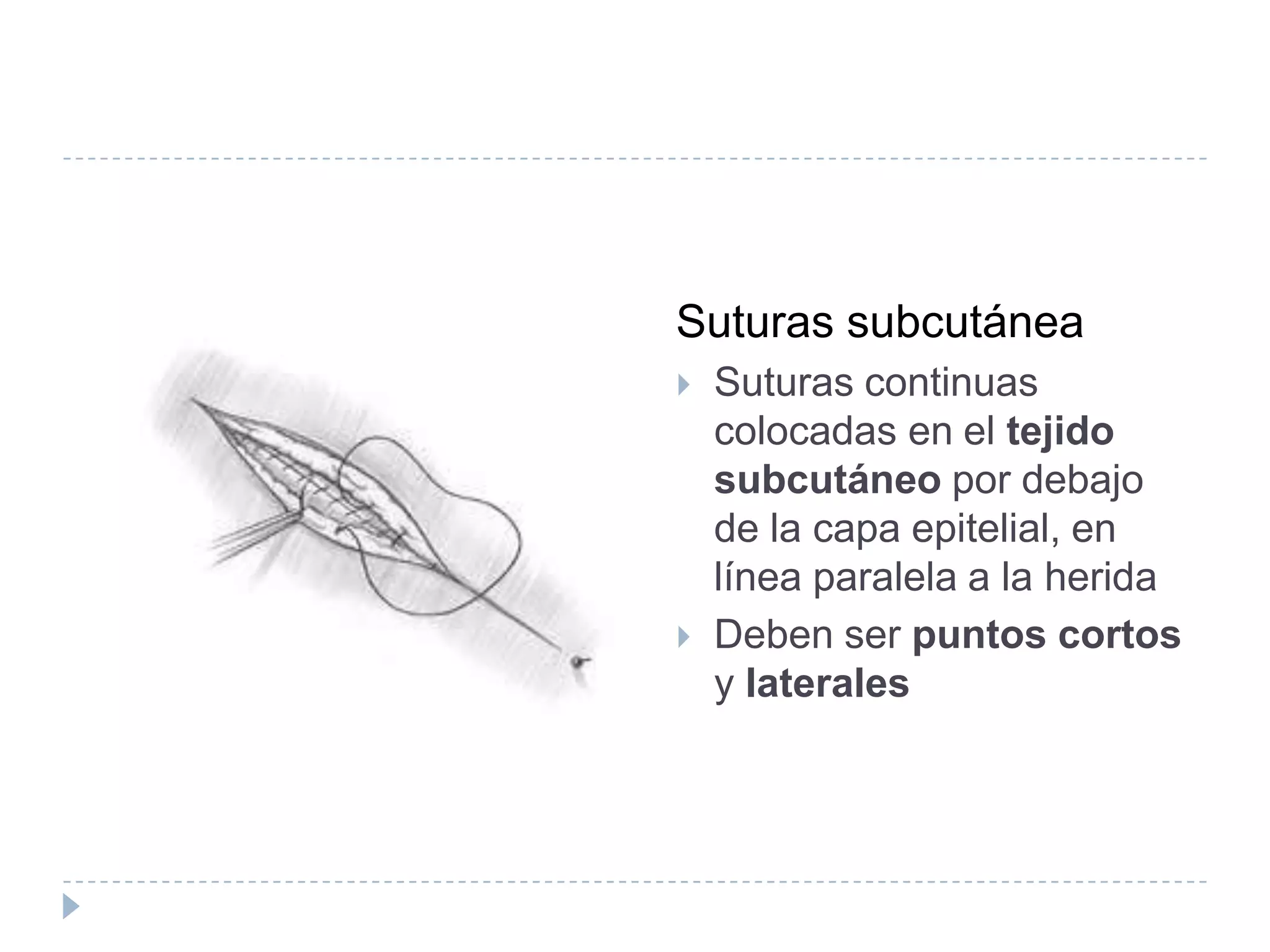 SUTURAS QUIRÚRGICAS | PPTX