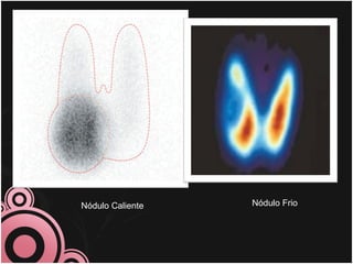 NODULO TIROIDEO | PPT